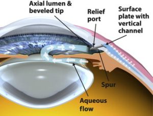 EX-PRESS® Glaucoma Filtration Device Procedure - Mitosol®
